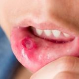 Canker Sores - OraWellness